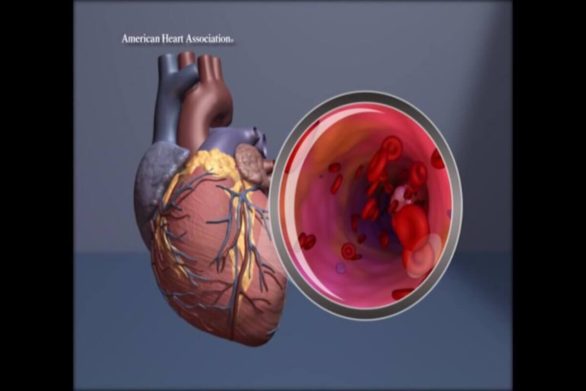 Young adults are having heart attacks more often -- What's causing it?