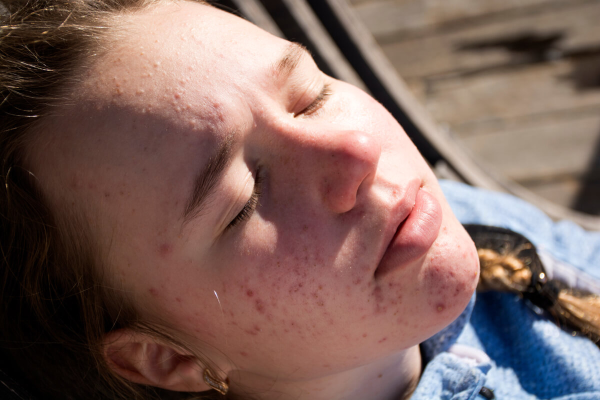 TikTok's sunburning hack won’t heal acne – and could be a fatal mistake
