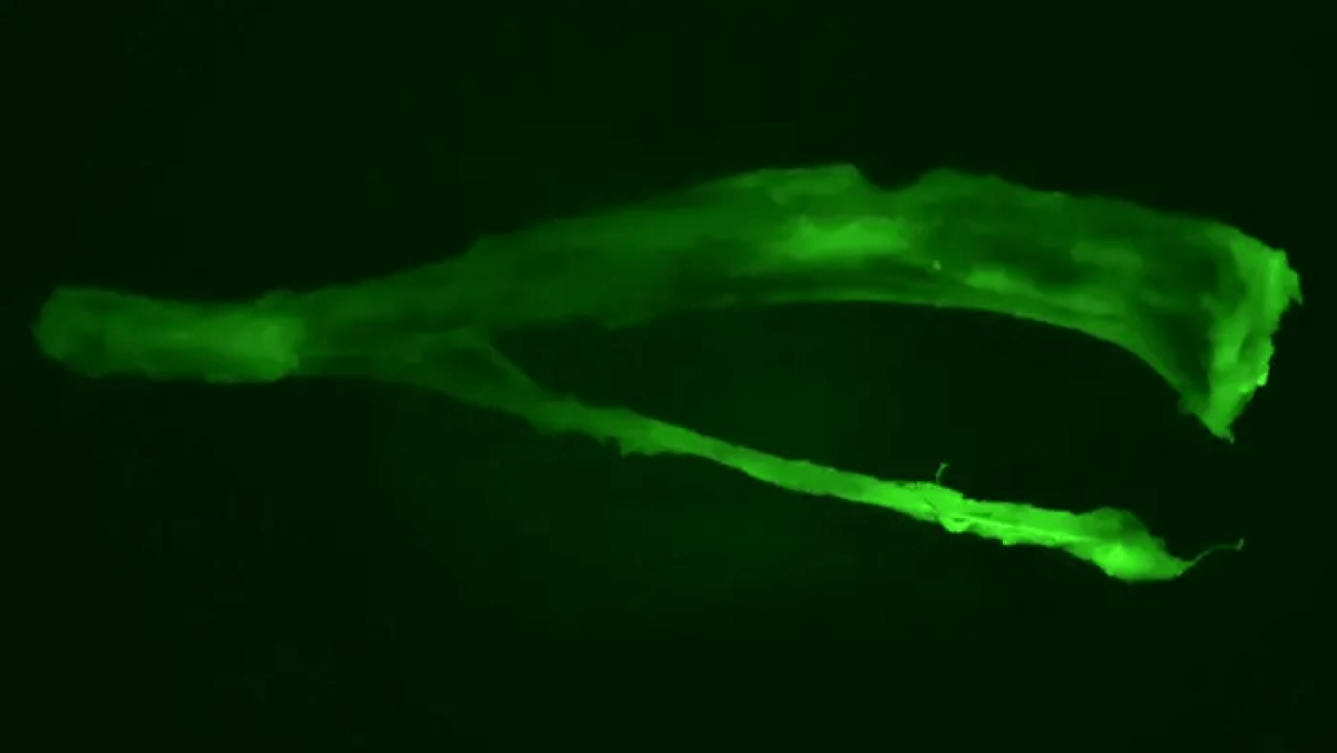 Cancer breakthrough finally maps how deadly tumors spread through the body