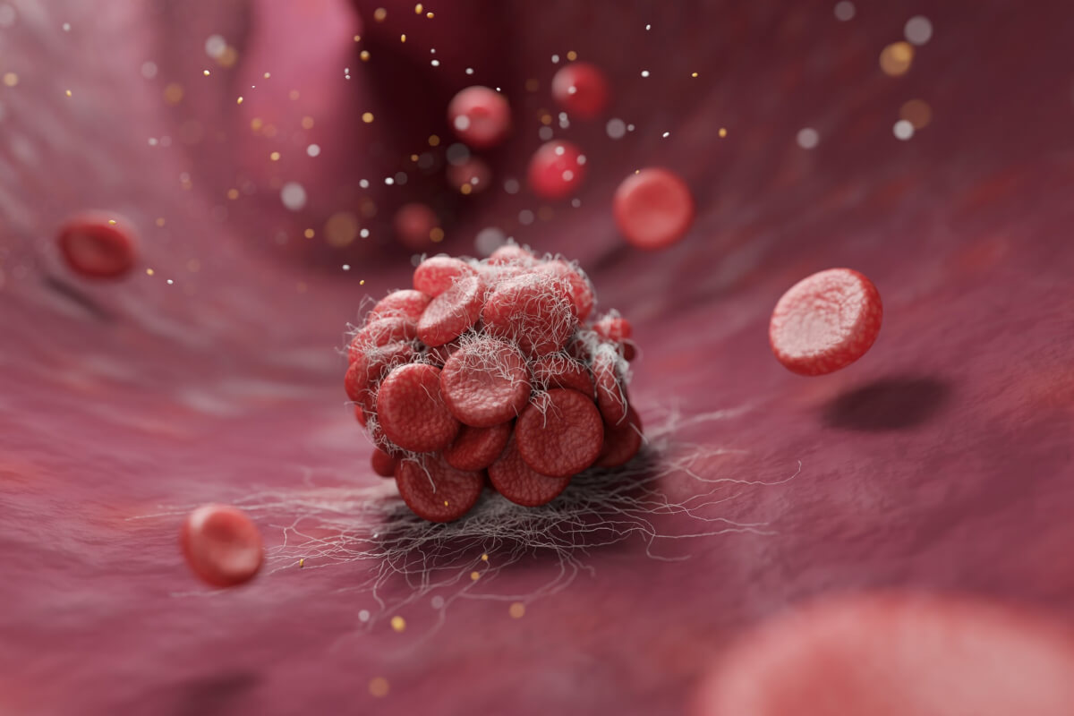 Deadly blood clots affect 22 million yearly — Could light therapy be ...