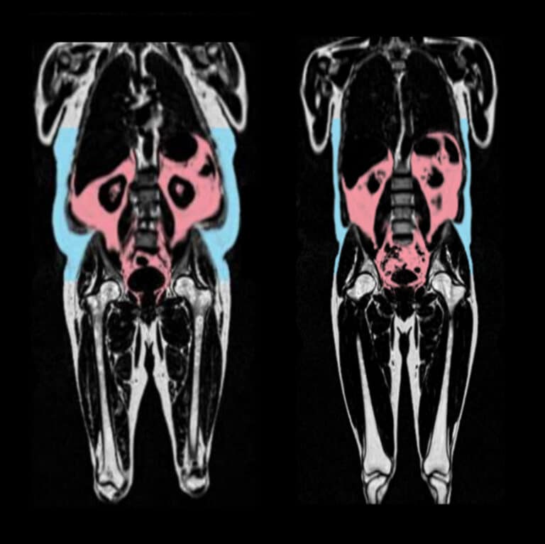 Organ-Hugging 'Skinny Fat' Puts Health At Risk In People With Normal BMI